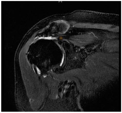Rotator Cuff Tear