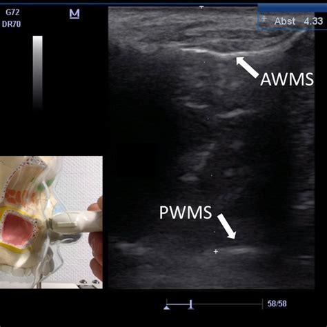 B Scan Us Of Corresponding Maxillary Sinus From Figure 2 The Osseus Download Scientific