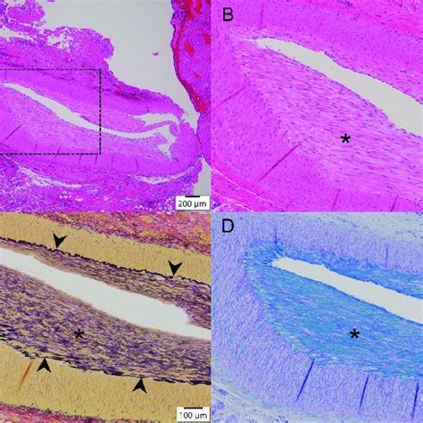 Histopathological Pictures Of Resected Superficial Temporal Artery A Download Scientific