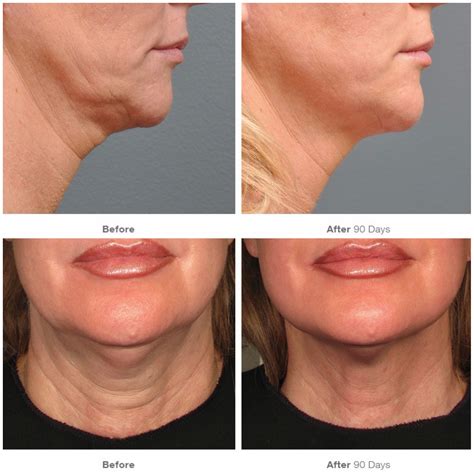 Should You Be Afraid Of Ultherapy Review Side Effects And Cost