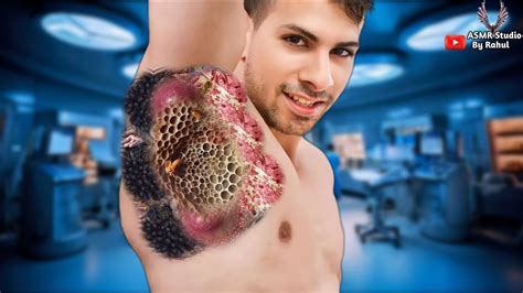 Asmr Animation Treatment From Infected Armpit Asmr Treatment