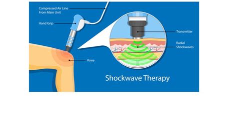 Radial Shock Wave Therapy Physiotherapy Posture And Fitness Clinic