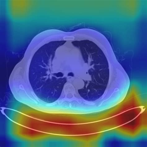[d] [r] research problem about weakly supervised learning for ct image semantic segmentation r