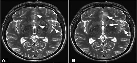 Cryptococcal Meningitis With Immune Reconstitution Inflammat Journal Of Neuro Ophthalmology