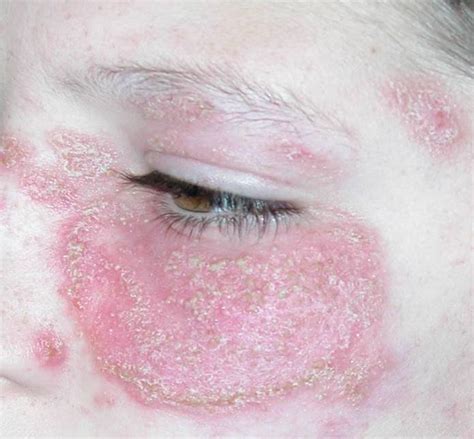 Eyelid Dermatitis Xeroderma Of The Eyelids Eczema Of The Eyelids