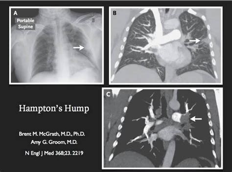 Pulmonary Embolism Hampton Hump A Classic Pulmonary Embolism
