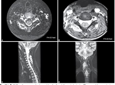 Figure 1 From Osteoid Osteoma Of The Cervical Spine In Nine Years