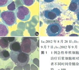 低增生性急性白血病多图 39医疗图集 39健康网