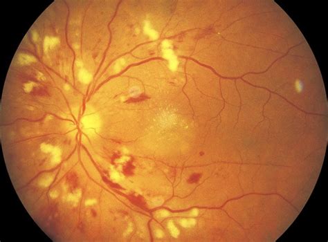Hypertensive Retinopathy Oasiseye Specialists