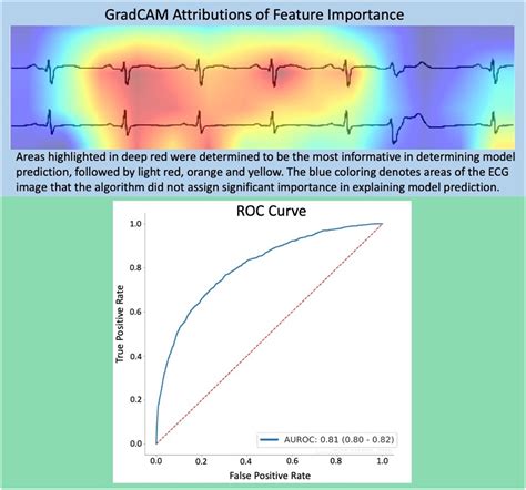 Po 04 154 A Novel 12 Lead Ecg Based Deep Learning Algorithm To Predict Cardiomyopathy In