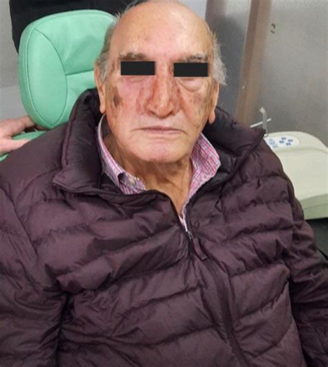 Total Rhinectomy With Prosthesis Placement As A Treatment For