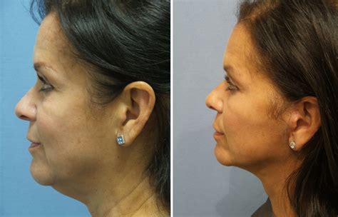 Face And Neck Lift 23 Dr Schalit Cosmetic Facial Specialist