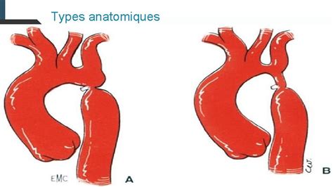Coarctation De Laorte Introduction La Coarctation Aortique Est