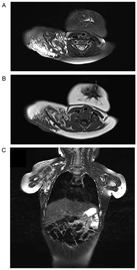 Khe With Diffuse Abnormal Signal With Ill Defined Border And Irregular Download Scientific