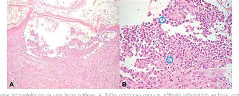 Figure 1 From Cutaneous Lesions Uncovering Systemic Cryptococcosis In An Hiv Positive Patient