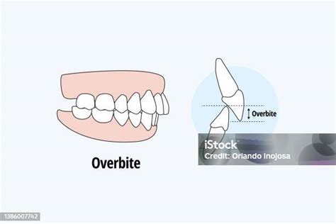 측면 오버바이트 치과 문제 벡터 일러스트레이션 치과 치료 개념 치과 장비에 대한 스톡 벡터 아트 및 기타 이미지 치과 장비 치아 건강 치아교정기 Istock