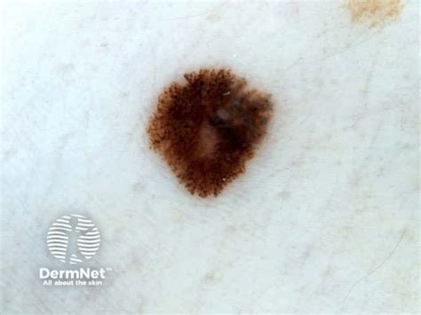 Dermoscopy Pattern Analysis