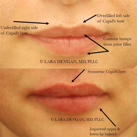 Bump On Upper Lip