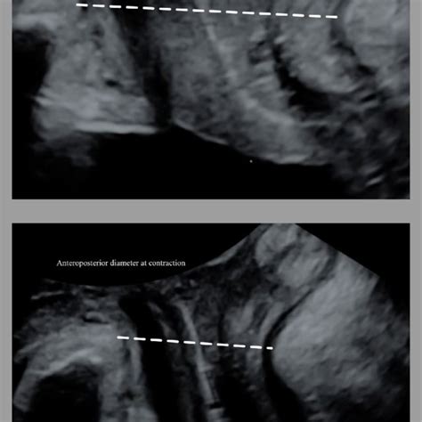 Levator Ani Muscle Intact Levator Ani Muscle Top Illustrated By Download Scientific Diagram