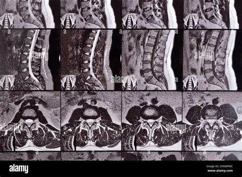 Mri Of A Patient With Intervertebral Disc Protrusion And