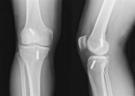 Pediatric Open Growth Plate Acl Reconstruction Orthopedic Surgeon