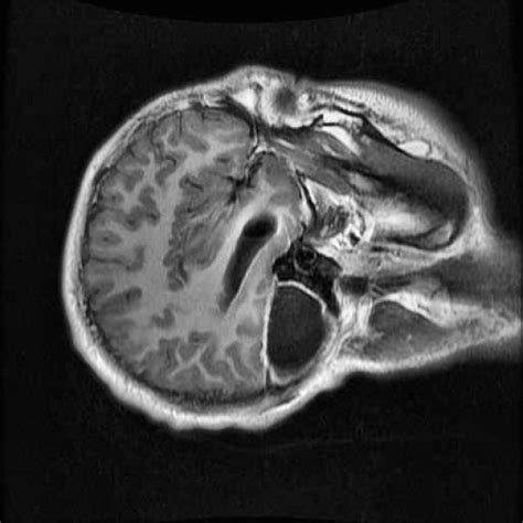 Brain Tumor Detection Object Detection Dataset And Pre Trained Model By Nuzhaysh