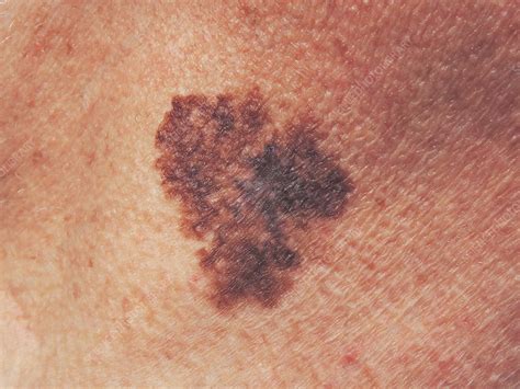 Lentigo Maligna Melanoma Stock Image C0461648 Science Photo Library