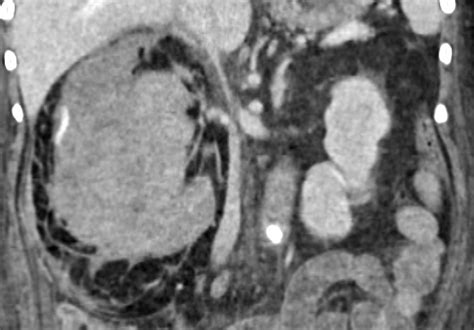 002k Post Biopsy Pseudoaneurysm Hemorrhage Subcapsular Hematoma Post