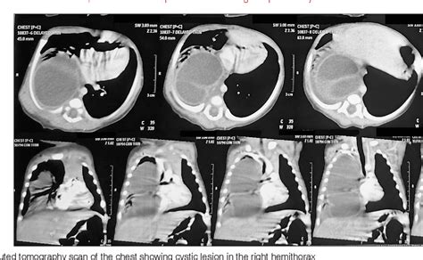 Figure 1 From Thoracoscopic Resection Of Foregut Duplication Cyst In A Neonate Semantic Scholar
