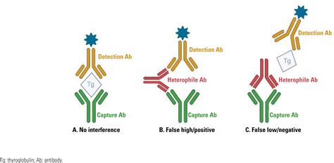 False Diagnosis Of Recurrent Thyroid Carcinoma The Importance Of Testing For Heterophile