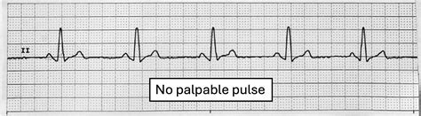Pulseless Electrical Activity Ecg Strip Pulsenotes Rate And Rhythm