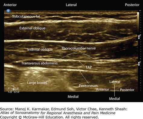 Sonoanatomy Relevant For Ultrasound Guided Abdominal Wall Nerve Blocks Anesthesia Key