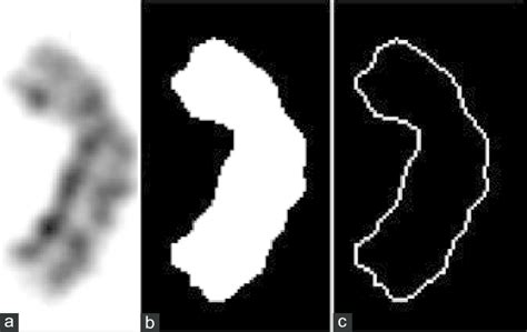 Segmentation Of The Chromosome A Original Image B Segmented Image