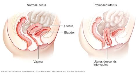 Uterine Prolapse Punarva