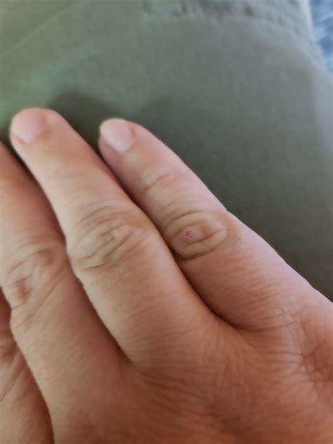 Pimple On Pinky Knuckle Rmedicaladvice