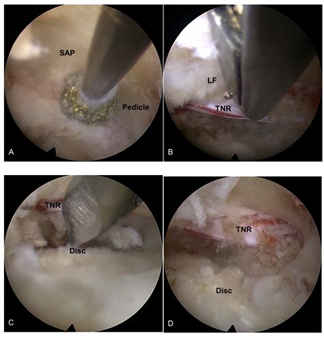 Left Lateral Recess Stenosis