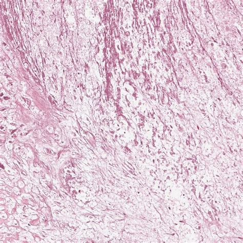 Types Of Osteosarcoma Images A Non Viable Tumor B Non Tumor C Download Scientific Diagram