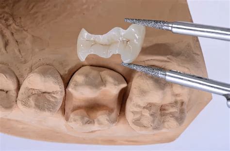 Indirect Composite A Great Restorative Option