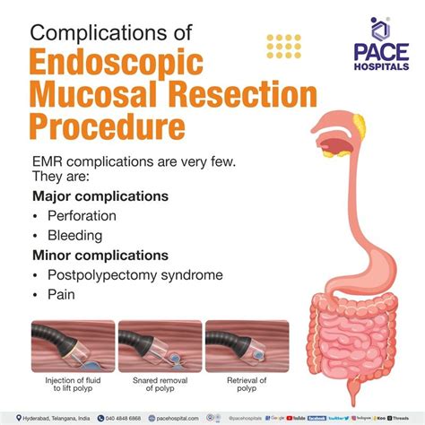 Endoscopic Mucosal Resection In Hyderabad India Indications And Cost