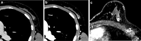 Virtual Monochromatic Spectral Ct Imaging In Preoperative Evaluations For Intraductal Spread Of