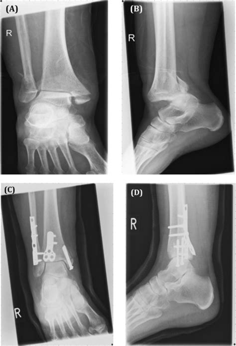 Trimalleolar Ankle Fracture Recovery