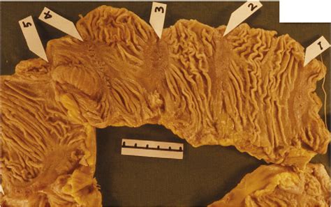 Typical Macroscopic Findings Of The Resected Ileum In A Case Of Cnsu Download Scientific