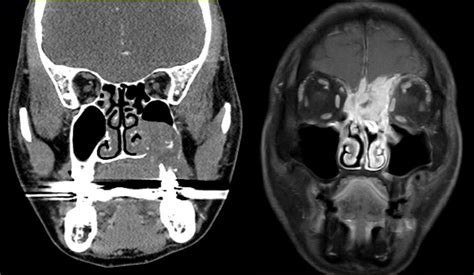 서울대학교암병원