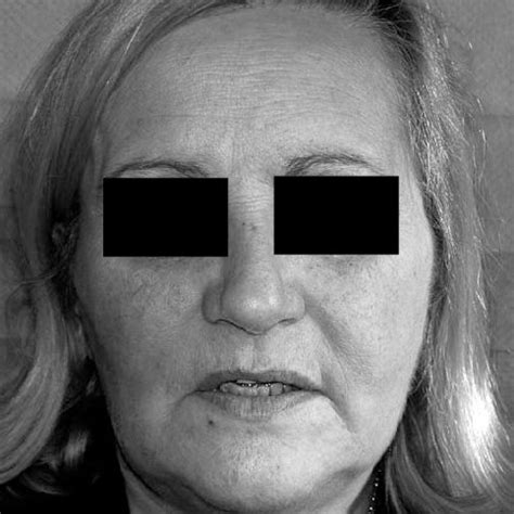 Post Operative Frontal View Of A Patient With Temporal Defect Download Scientific Diagram