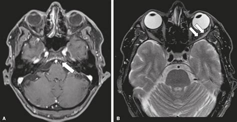 Imaging Of Cranial Nerves A Pictorial Overview Insights 49 Off