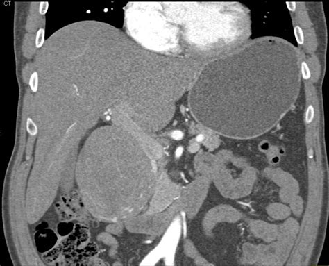 Duodenal Gist Tumor With Mild Neovascularity Simulates A Pancreatic