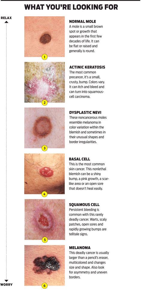 Cancerous Scalp Lesions