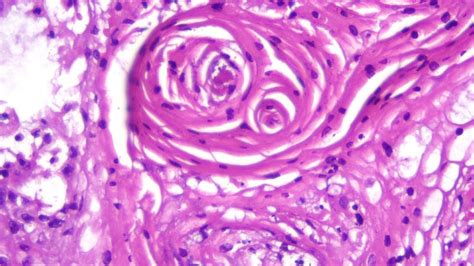 Scc Of Bladder Belajar Patologi