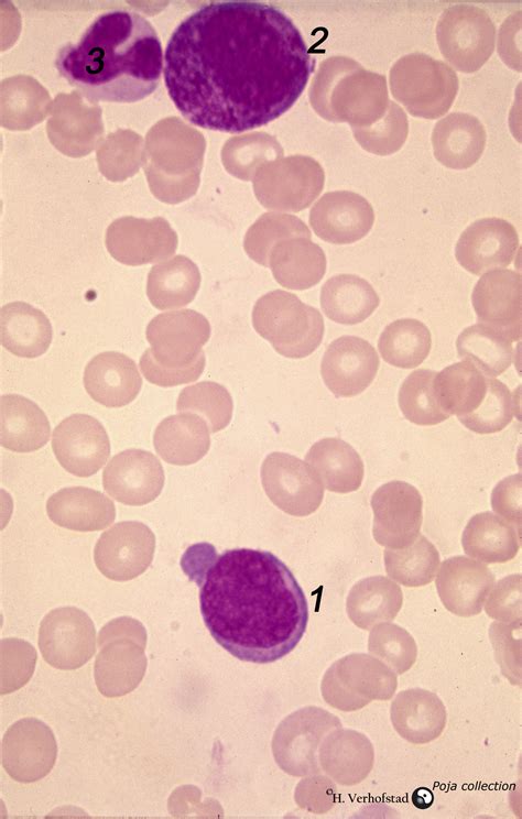 Myeloblast