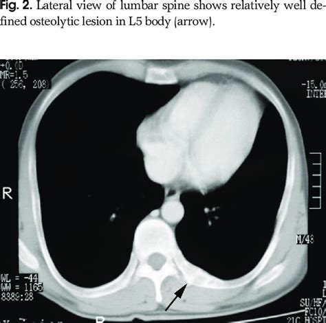 Chest Ct Scan Shows Expansile Osteolytic Lesion Without Cortical